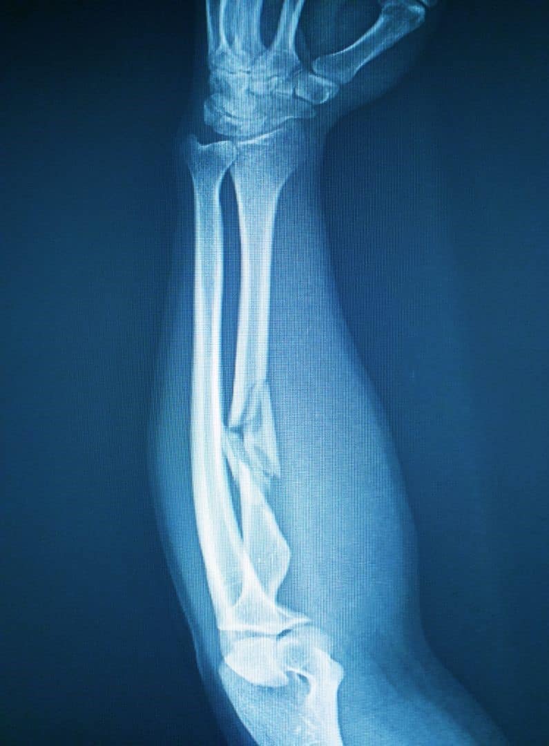 How Osteopathy could help you recover from a fracture - Tim Wood Healthcare